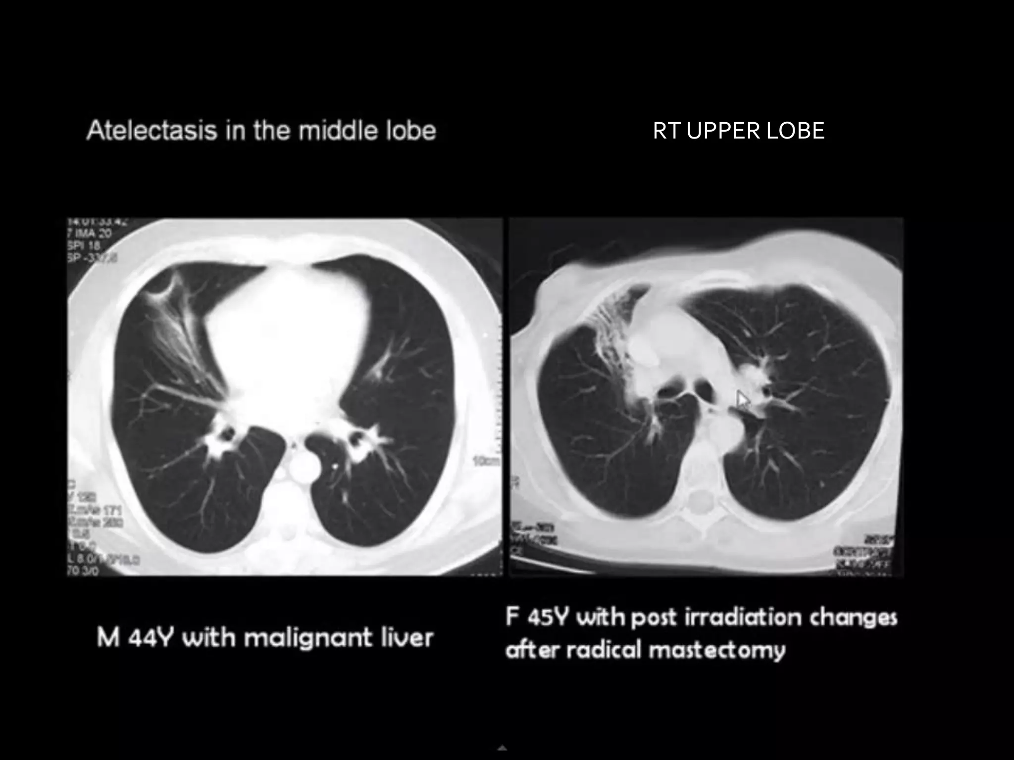 CT CHEST ANATOMY | PPTX