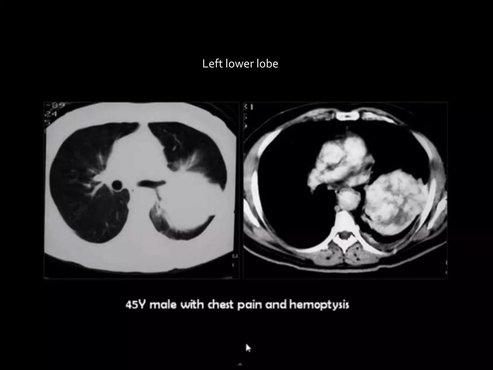 CT CHEST ANATOMY | PPTX