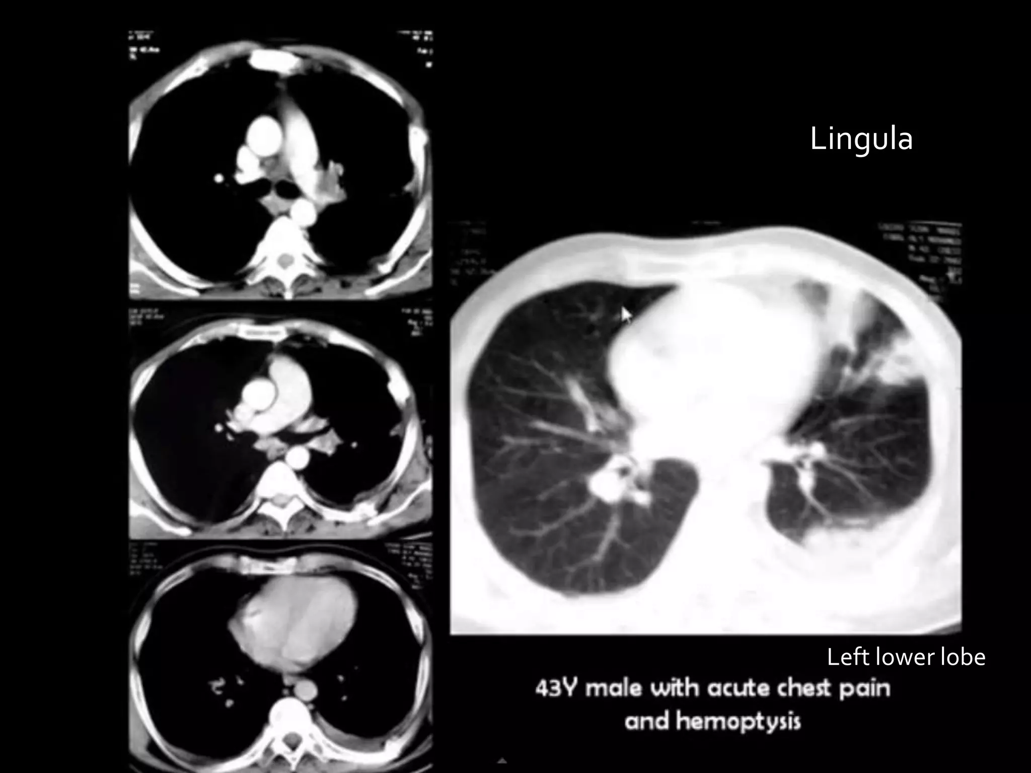 CT CHEST ANATOMY | PPTX