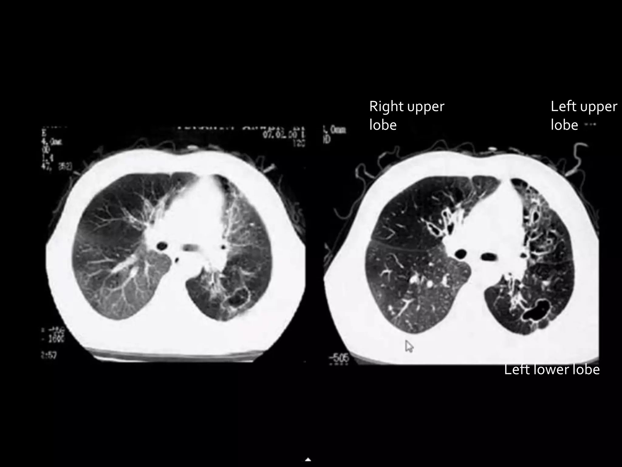 CT CHEST ANATOMY | PPTX