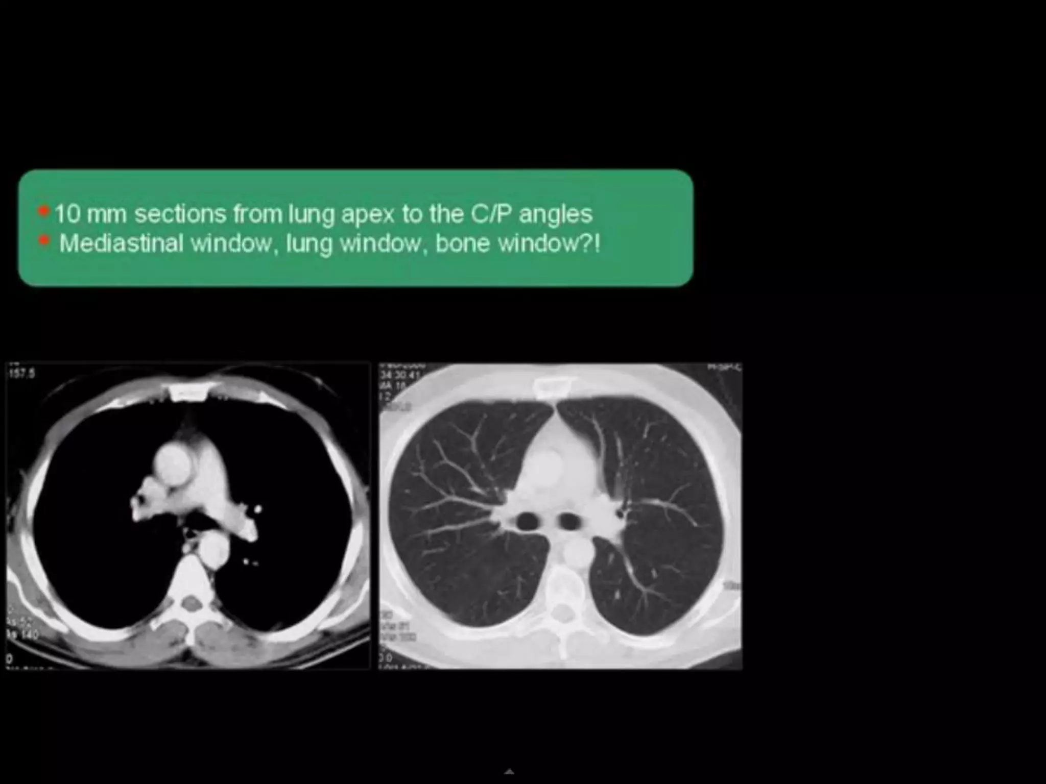 CT CHEST ANATOMY | PPTX
