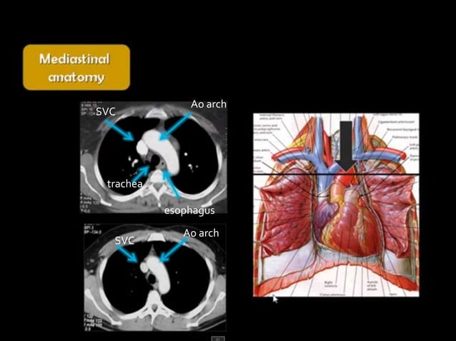 CT CHEST ANATOMY | PPTX