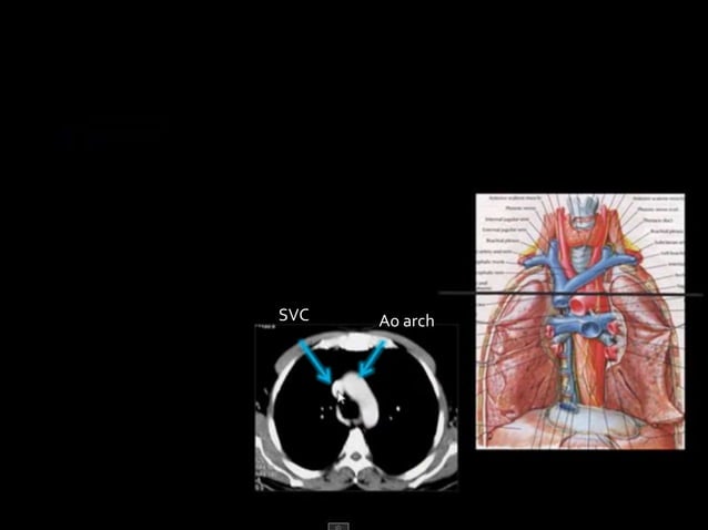 CT CHEST ANATOMY | PPTX