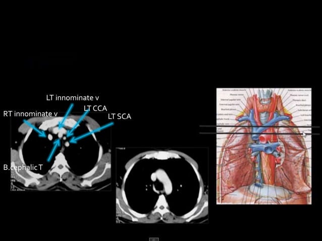 CT CHEST ANATOMY | PPTX