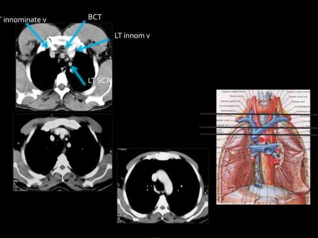 CT CHEST ANATOMY | PPTX