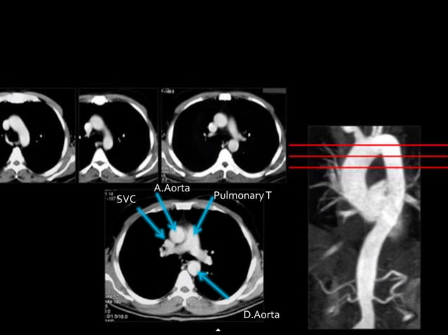 CT CHEST ANATOMY | PPTX