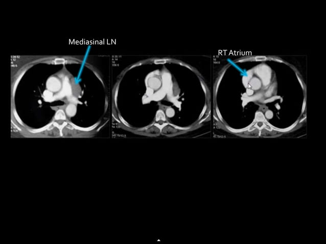 CT CHEST ANATOMY | PPTX