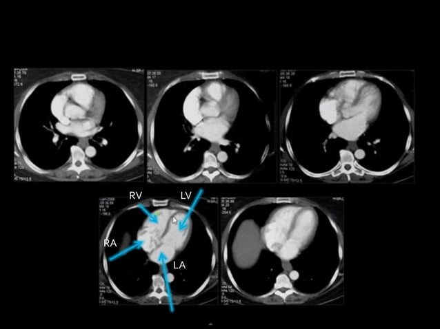 CT CHEST ANATOMY | PPTX