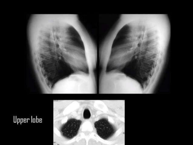 CT CHEST ANATOMY | PPTX