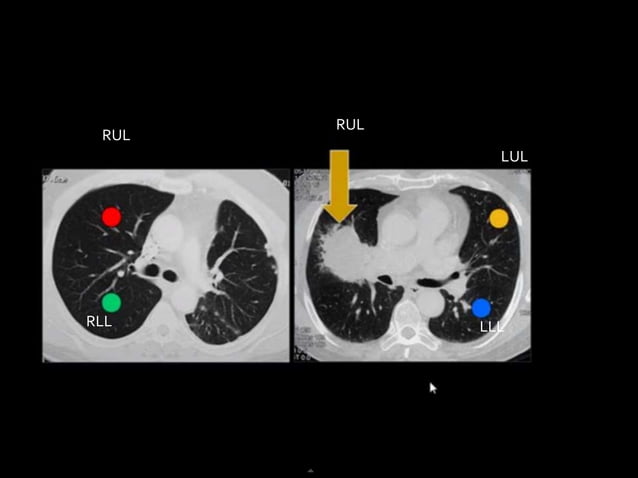 CT CHEST ANATOMY | PPTX