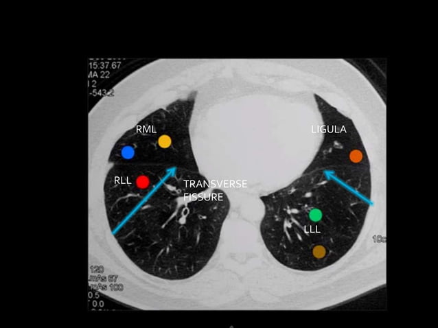 CT CHEST ANATOMY | PPTX