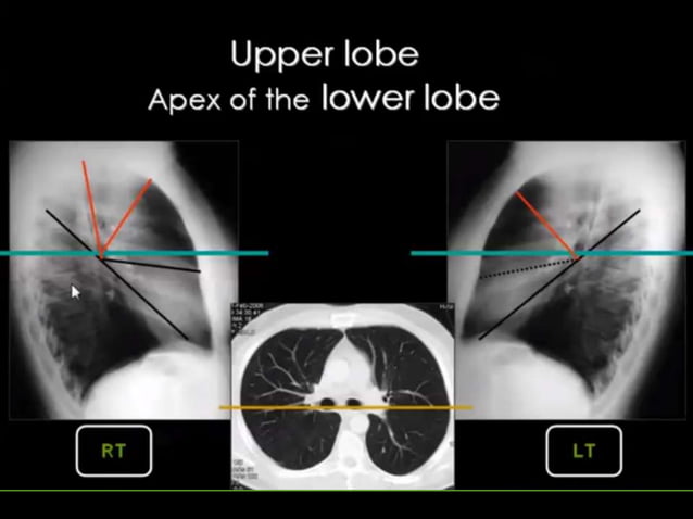 CT CHEST ANATOMY | PPTX