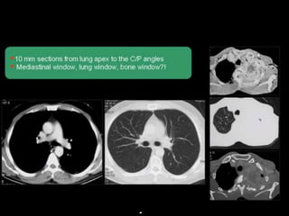 CT CHEST ANATOMY | PPTX