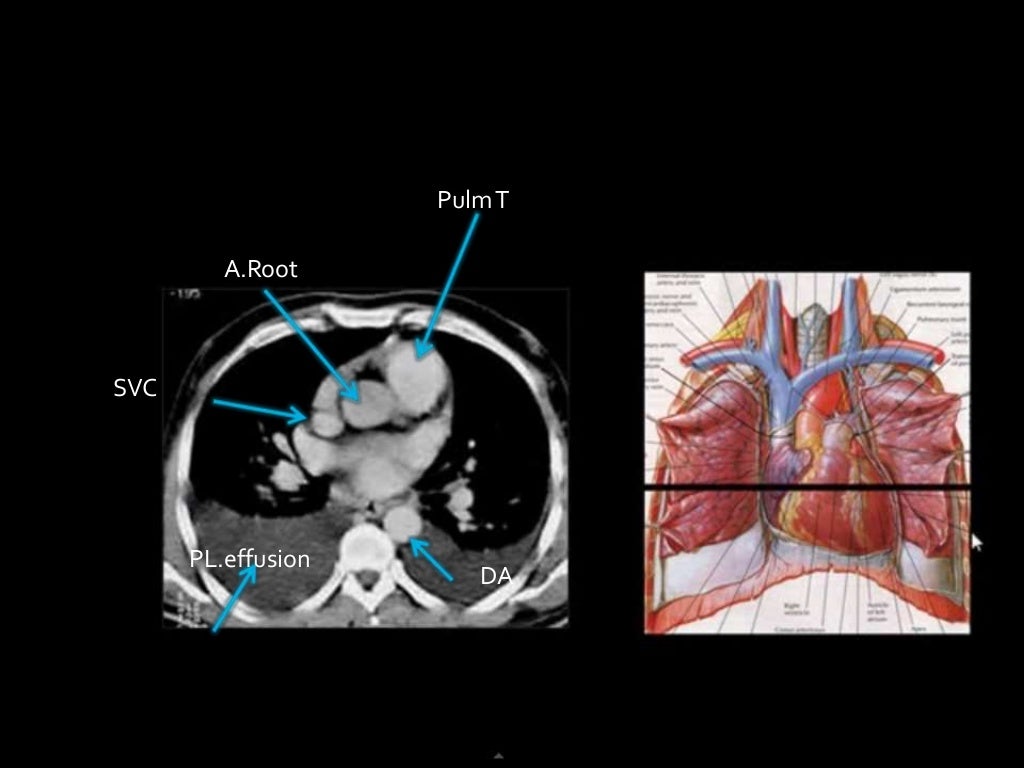 CT CHEST ANATOMY