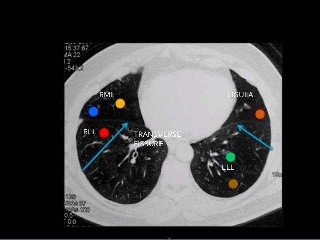 CT CHEST ANATOMY