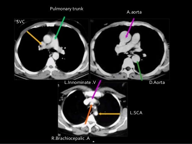 CT CHEST ANATOMY
