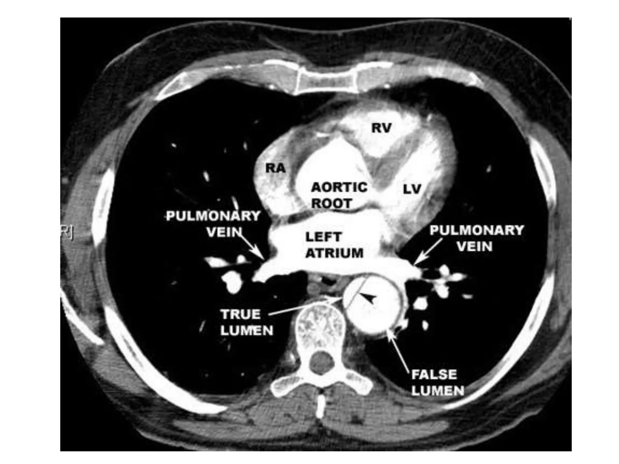 Ct chest anatomy | PPTX