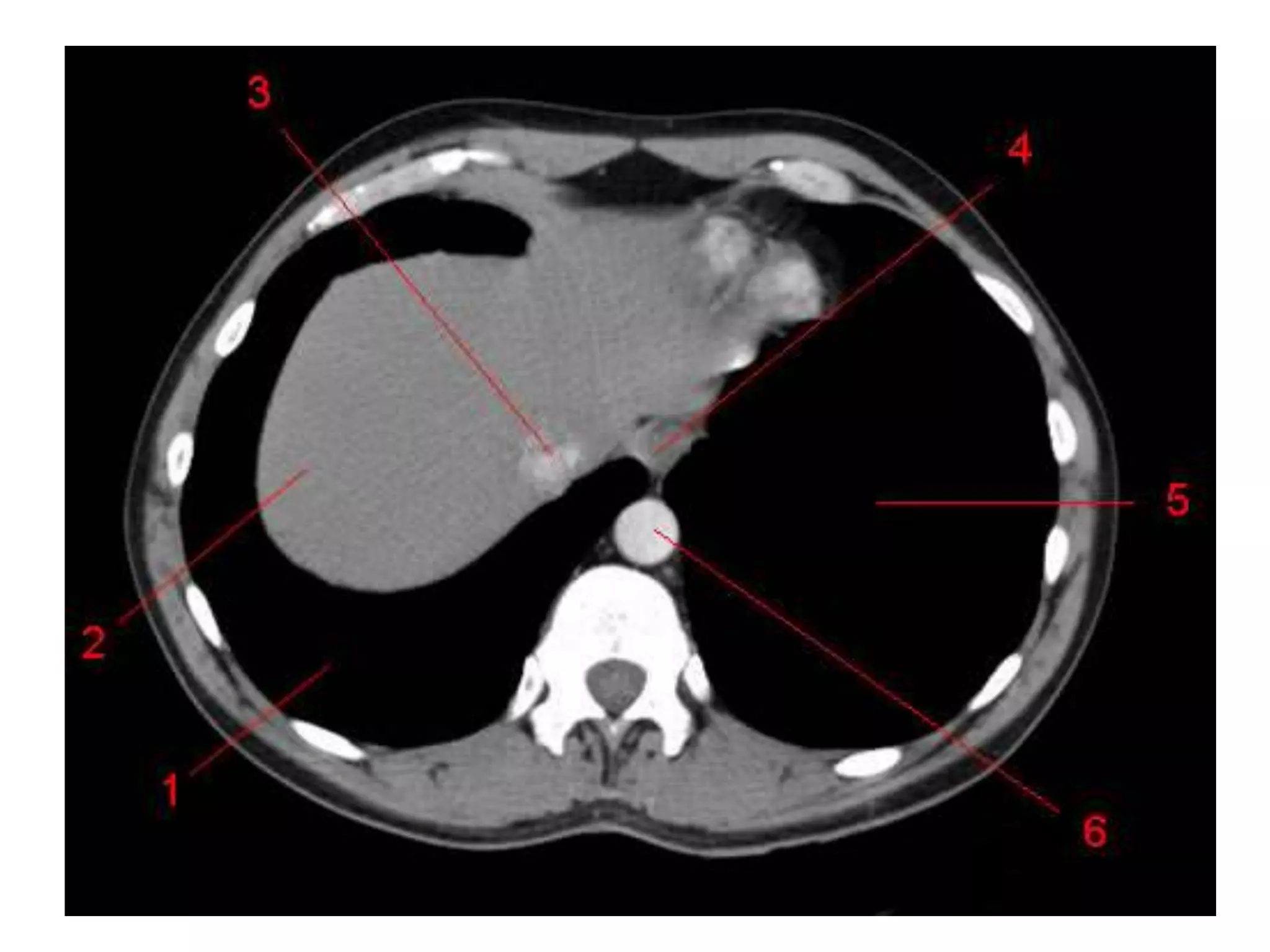 Ct chest anatomy | PPTX