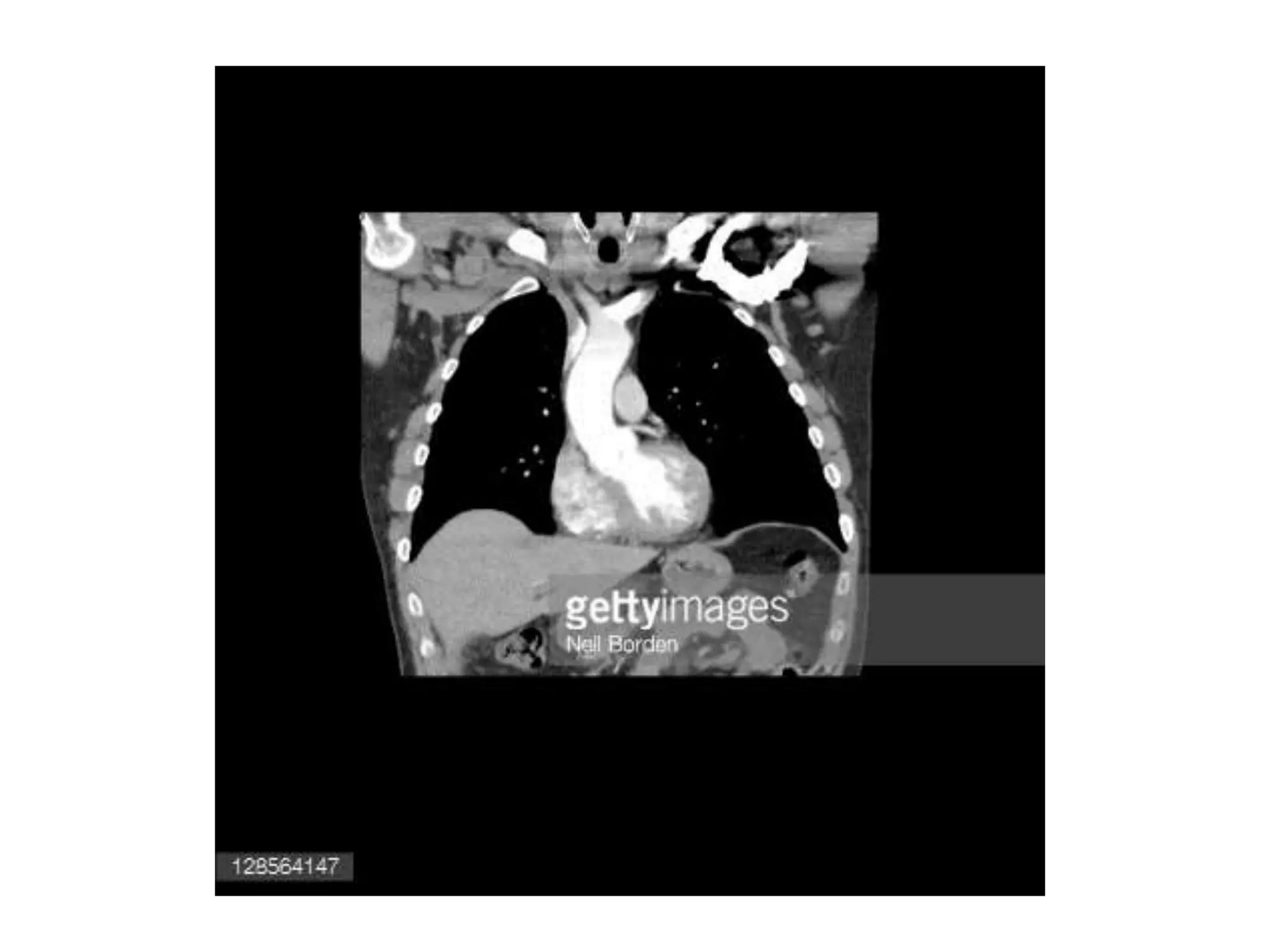 Ct chest anatomy | PPTX