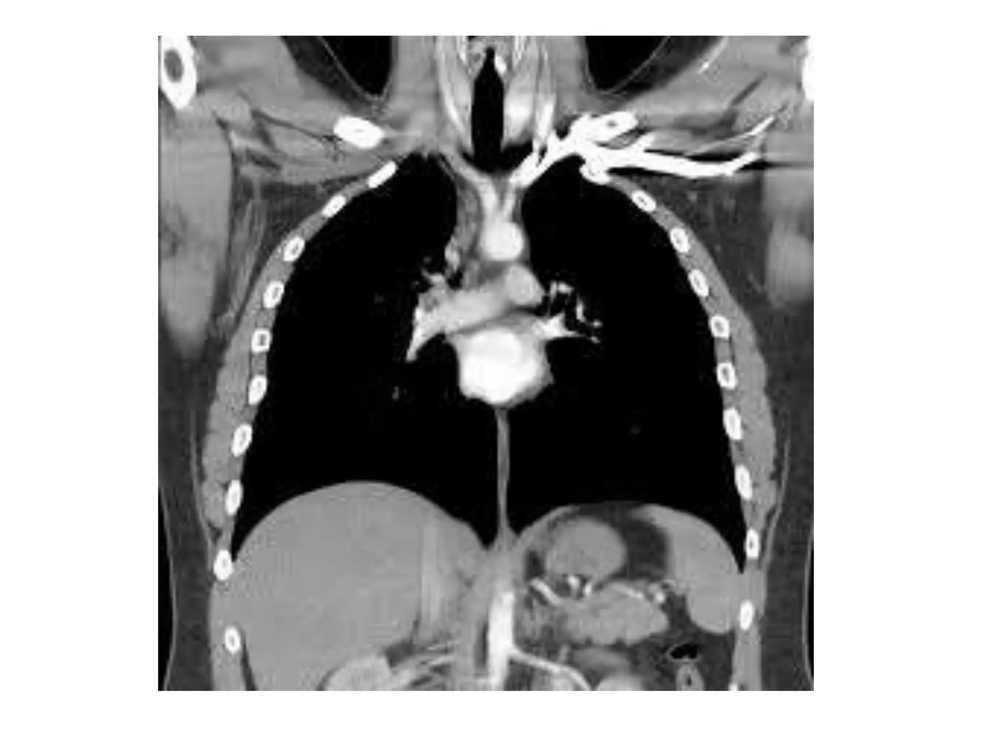 Ct chest anatomy | PPTX