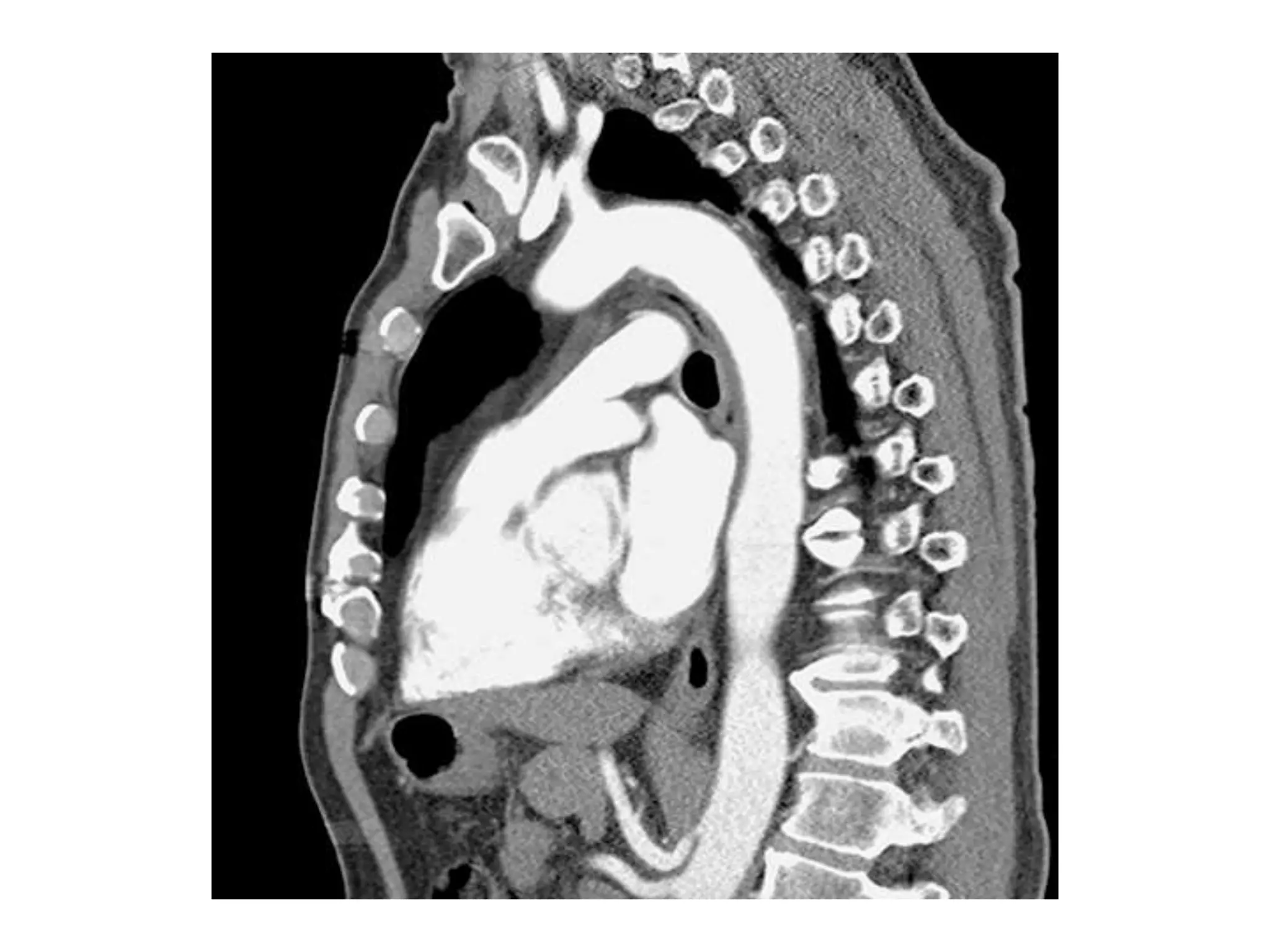 Ct chest anatomy | PPTX