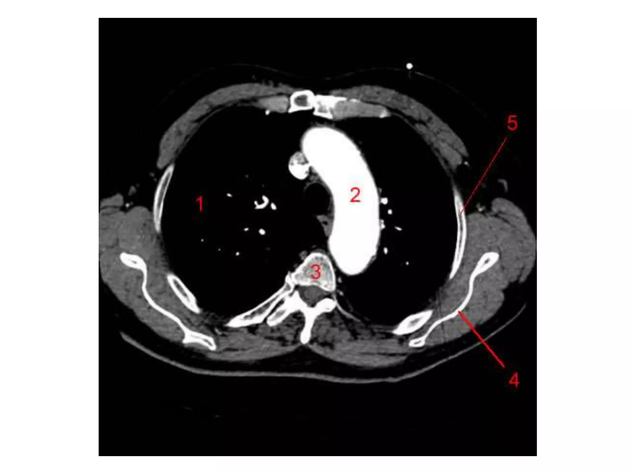 Ct chest anatomy | PPTX