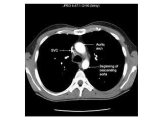 Ct chest anatomy | PPTX