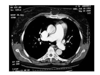 Ct chest anatomy | PPTX