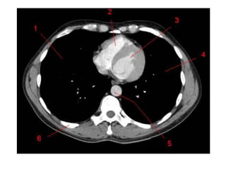 Ct chest anatomy | PPTX