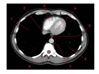 Ct chest anatomy | PPTX