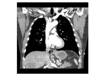 Ct chest anatomy | PPTX
