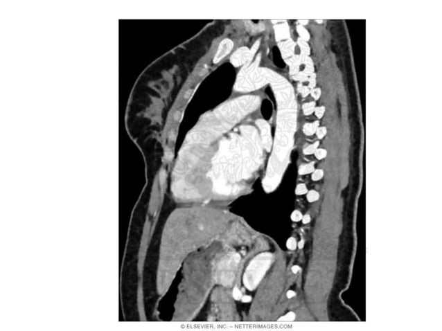 Ct chest anatomy | PPTX