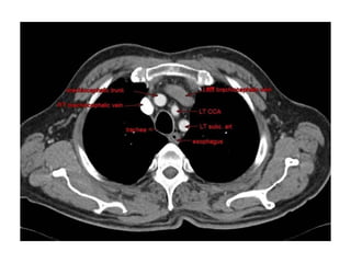 Ct chest anatomy | PPTX