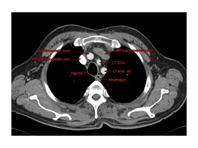 Ct chest anatomy | PPTX