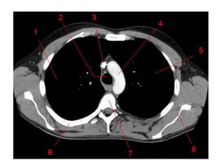 Ct chest anatomy | PPTX