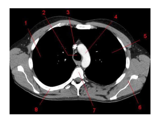 Ct chest anatomy | PPTX