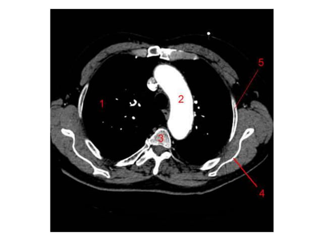 Ct Chest Anatomy Ppt