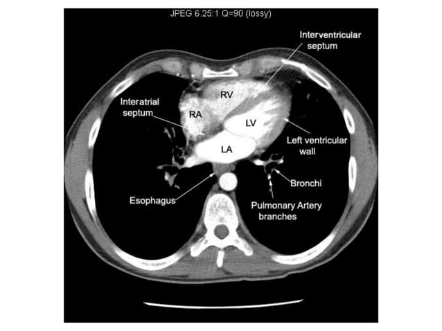 Ct chest anatomy