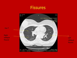 CT CHEST BASICS new.pptx - Basic interpretation of CT chest ...