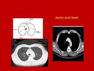 CT CHEST BASICS new.pptx - Basic interpretation of CT chest ...
