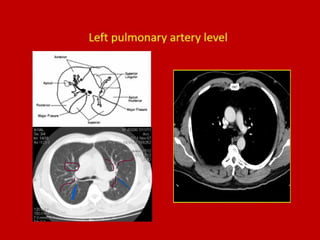 CT CHEST BASICS new.pptx - Basic interpretation of CT chest ...