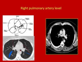 CT CHEST BASICS new.pptx - Basic interpretation of CT chest ...