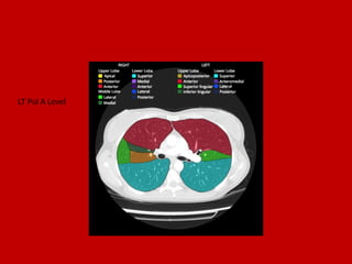 CT CHEST BASICS new.pptx - Basic interpretation of CT chest ...