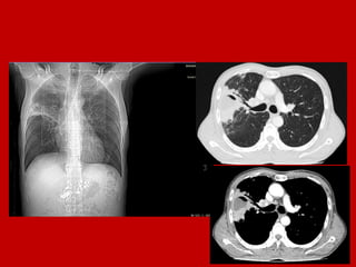 CT CHEST BASICS new.pptx - Basic interpretation of CT chest ...