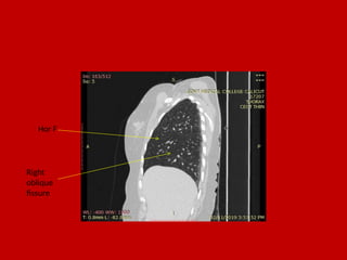 Basic interpretation of CT chest- identification of lobes and segments ...
