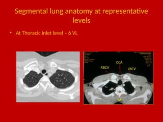 Basic interpretation of CT chest- identification of lobes and segments ...