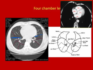 Basic interpretation of CT chest- identification of lobes and segments ...