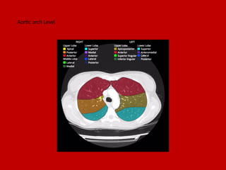 Basic interpretation of CT chest- identification of lobes and segments ...