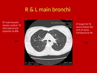 Basic interpretation of CT chest- identification of lobes and segments ...