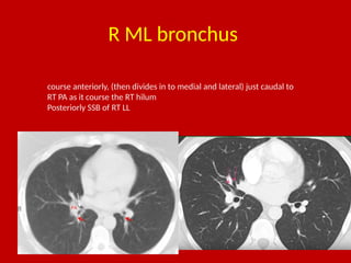 Basic interpretation of CT chest- identification of lobes and segments ...